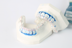 Kieferorthopädie / Aligner - Zahnarzt Ulm / Neu-Ulm - flexdent Zahnärzte