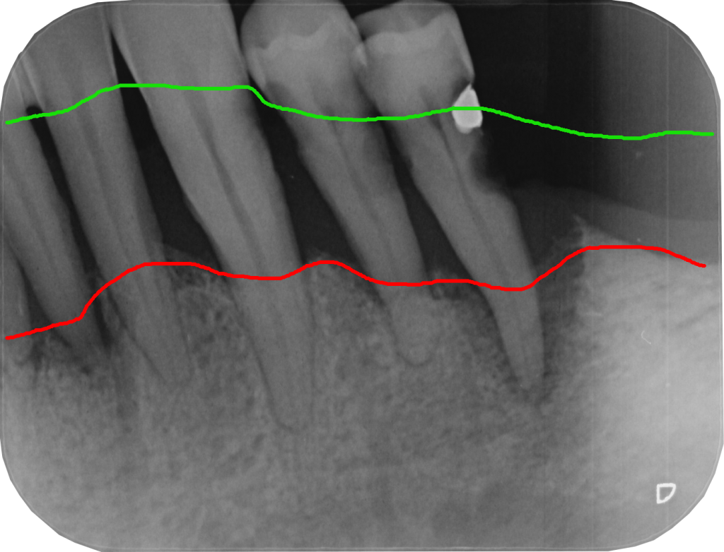 Parodontologie - Zahnarzt Ulm / Neu-Ulm - flexdent Zahnärzte
